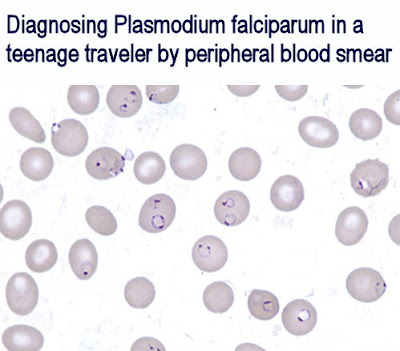 Peripheral Blood Smear Manual Differential - pushupload
