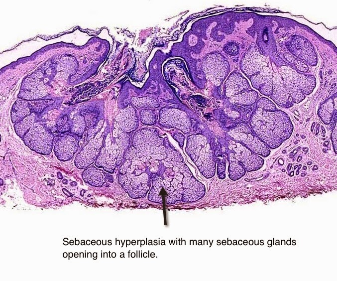 Dermpath Made Simple - Neoplastic: Sebaceous Tumours