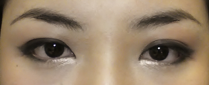 Fixing uneven eyelids without surgery