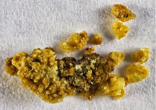 DICAS DE SAÚDE: Pedra nos rins (Calculo Renal) - Solução definitiva ...