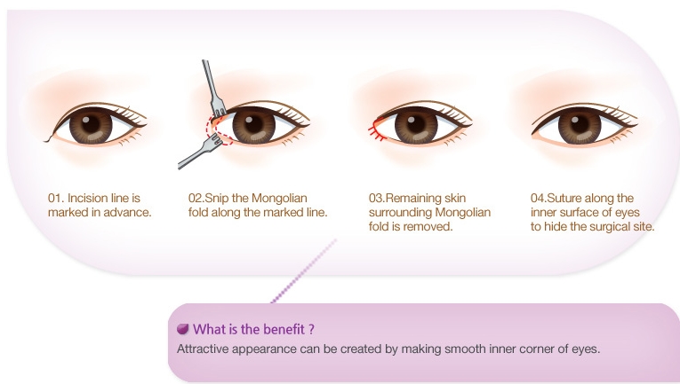 BK Plastic Surgery: [BK Plastic Surgery] Eyelid surgery:Inner Corner ...