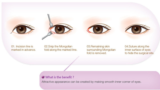 BK Plastic Surgery: [BK Plastic Surgery] Eyelid surgery:Inner Corner ...