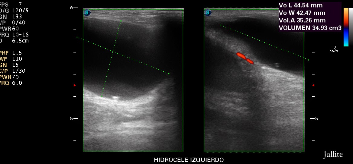 Hidrocele Bilateral y....