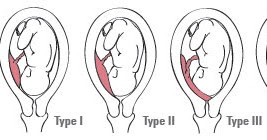 Living by Miriam: Lågt liggande moderkaka, Placenta previa eller ...