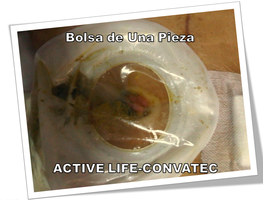 El blog del Paciente ostomizado: CARACTERISTICAS DEL ESTOMA, EL PRIMER ...