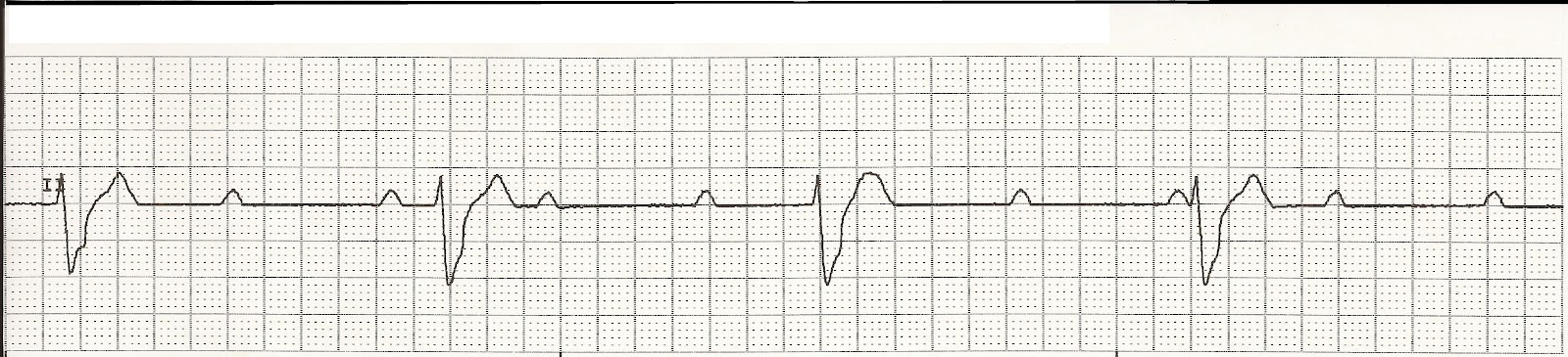 EKG Rhythm Strip Quiz 13