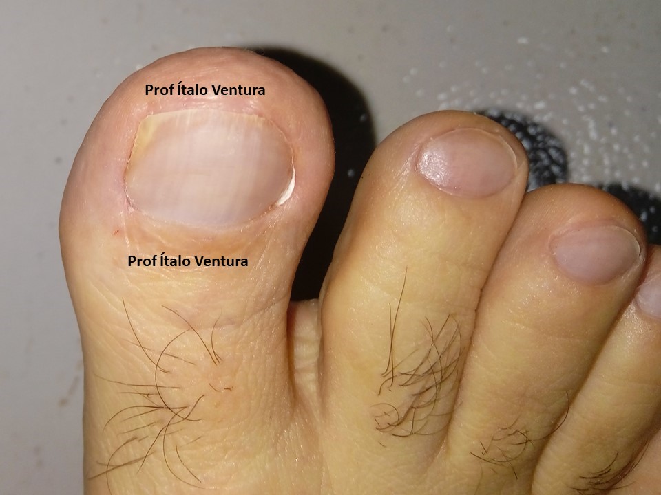 Dermatomicoses por fungos demáceos