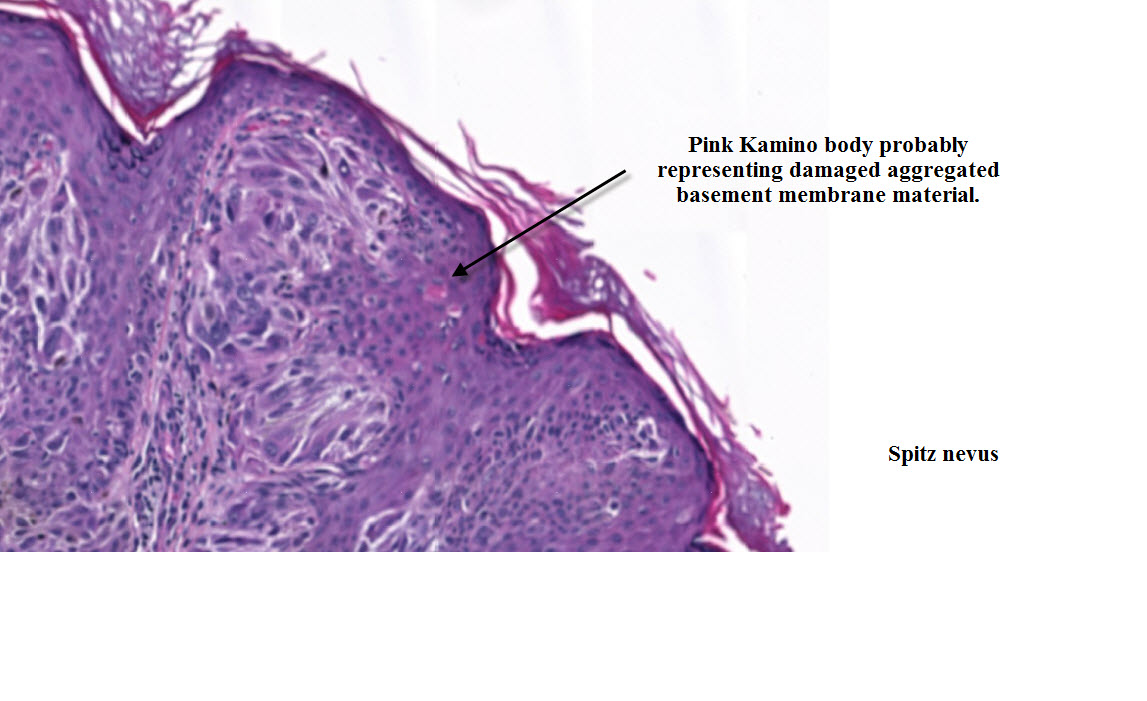 Dermpath Made Simple - Neoplastic: Spitz Nevus and Reed Nevus