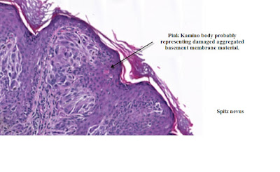 Dermpath Made Simple - Neoplastic: Spitz Nevus and Reed Nevus