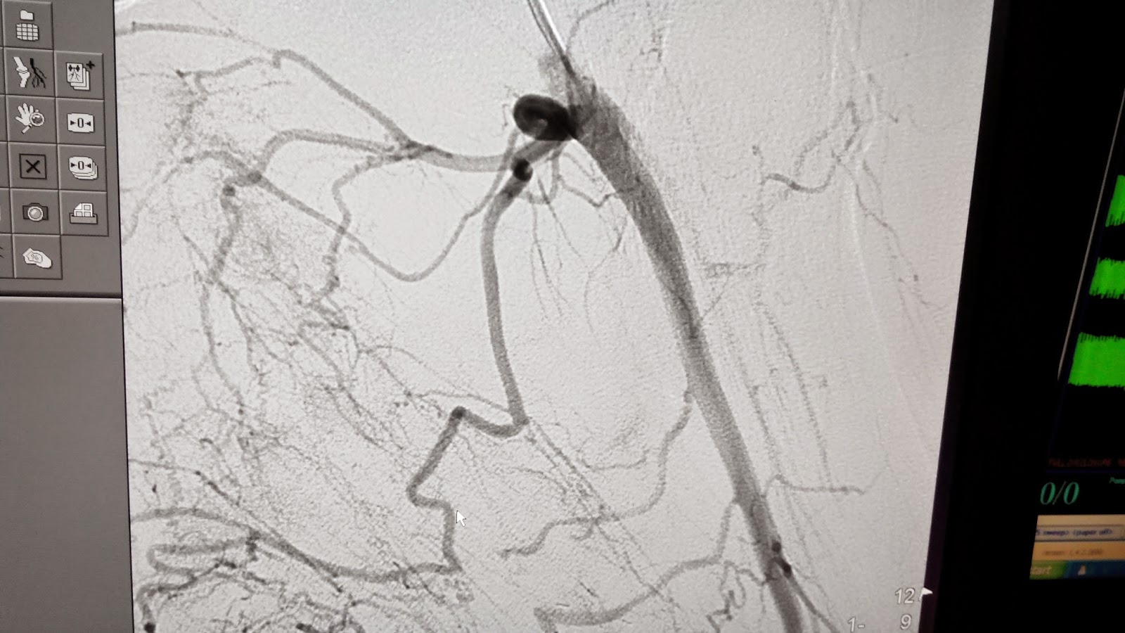 RUANG PRAKTEK BEDAH - DOKTER RAMZI SPB (K) V: Embolisasi carotis ...