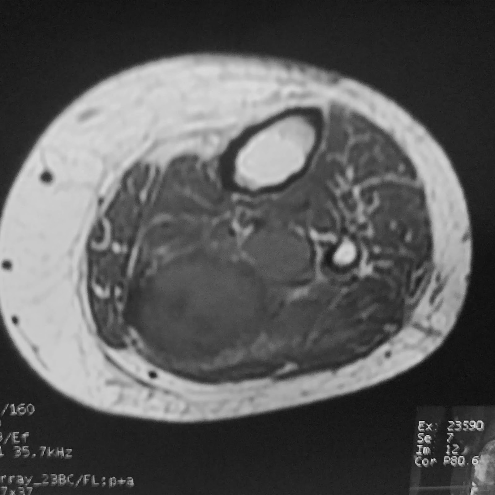 VIETNAMESE MEDIC ULTRASOUND: CASE 523: FIBULAR BONE TUMOR, Dr PHAN ...