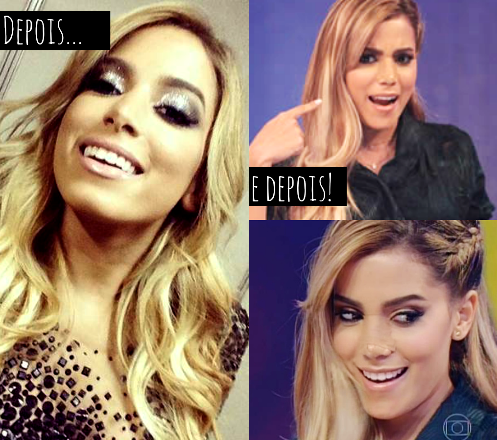 Anita Antes E Depois Da Plastica