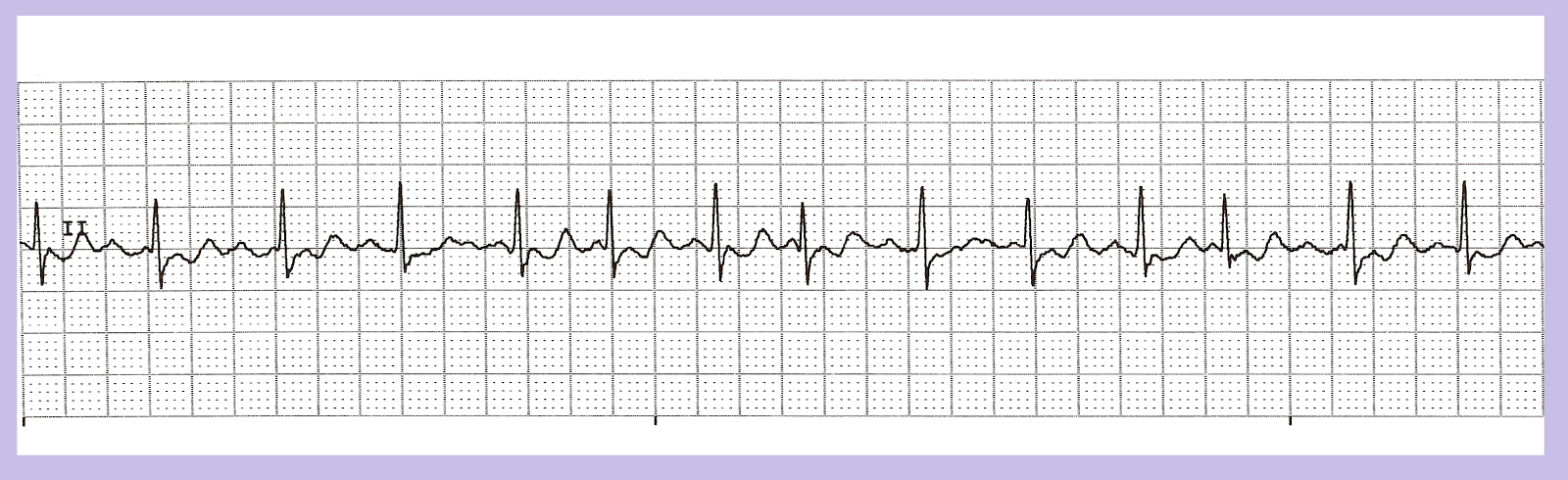 Various Multifocal Atrial Tachycardias