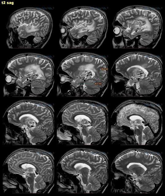 Radiology Archives: Αρτηριοφλεβώδης Δυσπλασία Εγκεφάλου (Spetzler ...