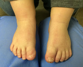 Congenital Hand and Arm Differences: Great Toe Polydactyly (extra toes)