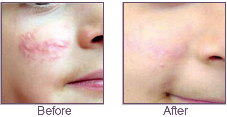 Medical Treatment Pictures-for Better Understanding: Scar Revision ...