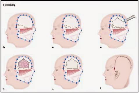 Medical Treatment Pictures-for Better Understanding: Brain Surgery ...