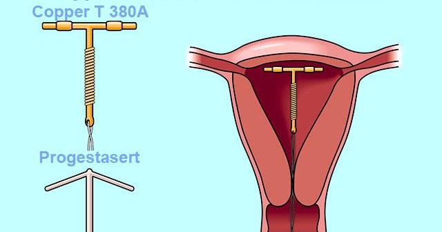 dunia hawa: Alat Kontrasepsi Dalam Rahim (AKDR) Intra Uterine Device (IUD)
