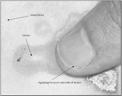 Nikolsky sign Positive, Symptoms, Causes, Treatment - Health Care Tips ...