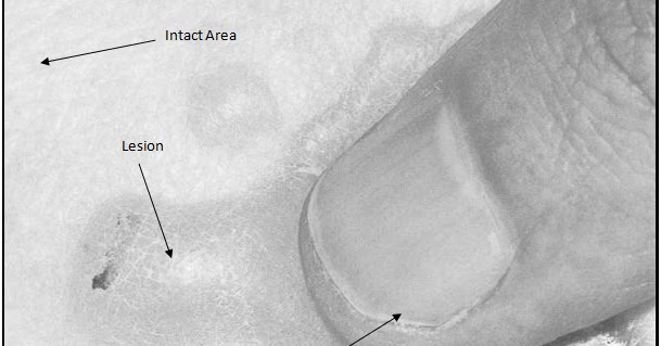 Nikolsky sign Positive, Symptoms, Causes, Treatment - Health Care Tips ...