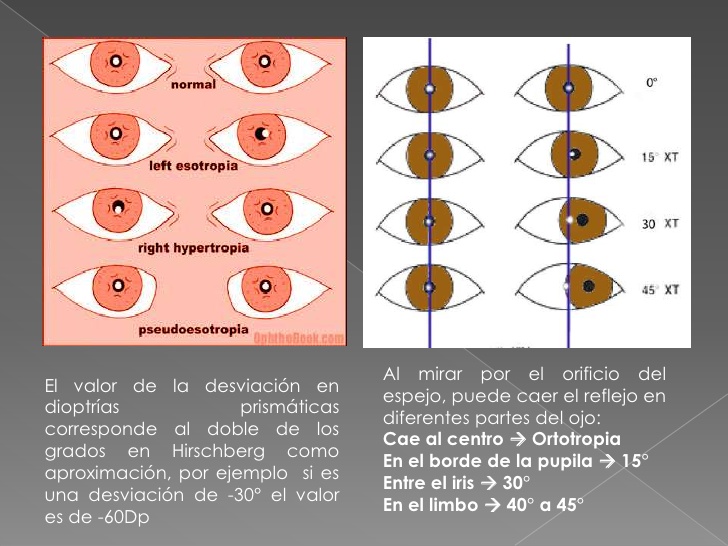 Test empleados en optometria : TEST DE HISCHBERG