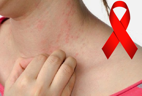 Penting! Ketahui Gejala HIV yang Sering Diabaikan Banyak Orang - Contoh ...