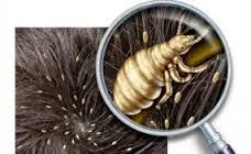 Cara Penularan dan pengobatan Kutu Kepala - Kamset.Blog