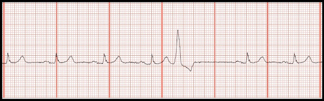 Practice EKG Rhythm Strips 126