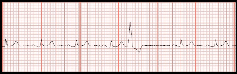 Practice EKG Rhythm Strips 126