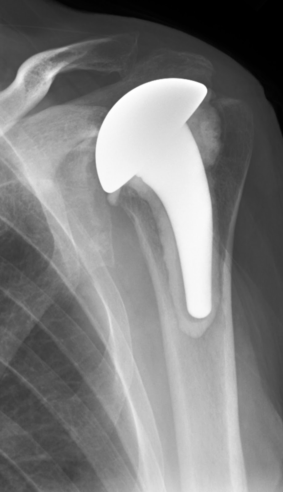 Shoulder Arthritis/Joint Replacement Rotator cuff tears: Shoulder joint ...