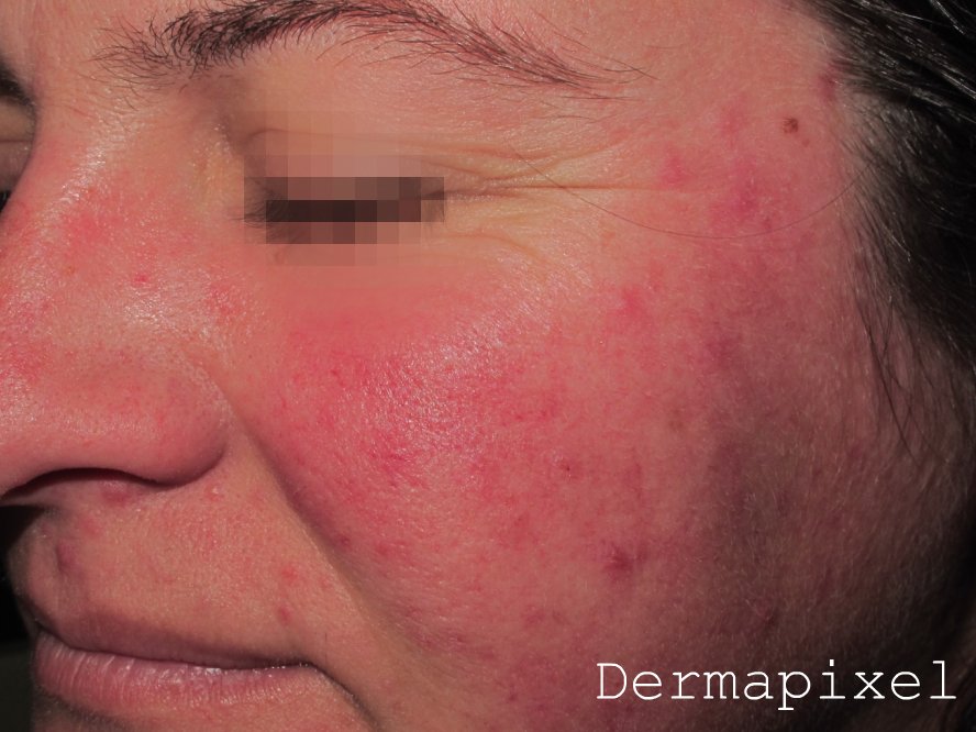 Dermapixel: junio 2012