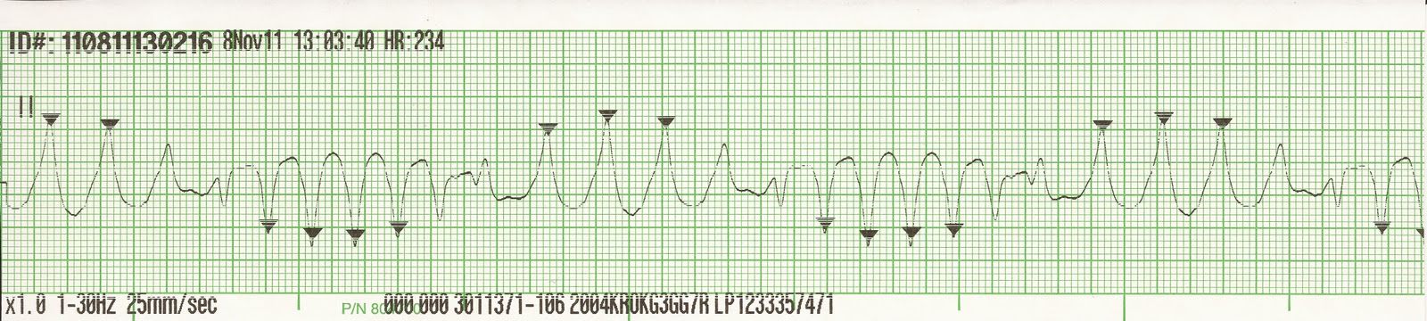Float Nurse: ACLS review: Wide Complex Tachycardia (WCT) Part 8
