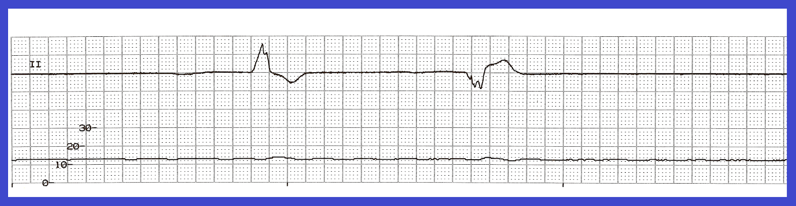 Various Agonal Rhythms