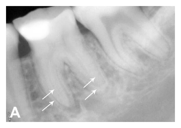 SUHASIS ONLINE: Four-Rooted Mandibular First Molar with an Unusual ...