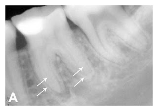 SUHASIS ONLINE: Four-Rooted Mandibular First Molar with an Unusual ...