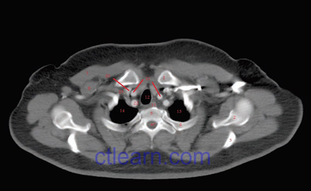 Anatomy CT Axial Chest