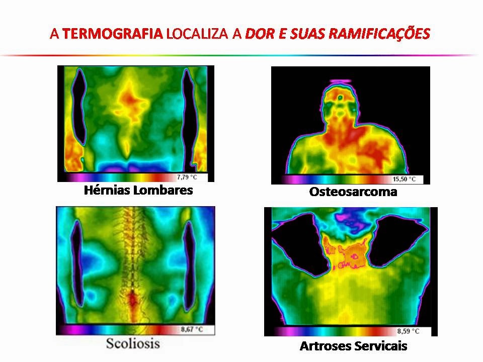 Termografia Medica