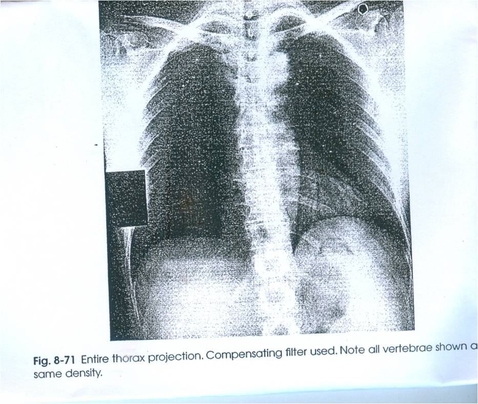 TEKNIK RADIOGRAFI THORACAL: TEKNIK RADIOGRAFI THORACAL