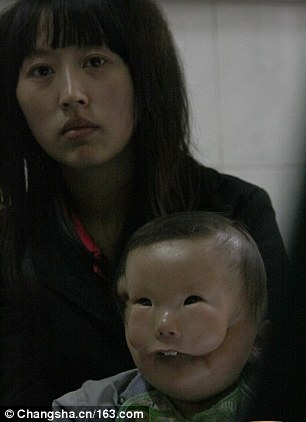 Meet China's 'mask boy': Child appears to have two faces due to rare ...
