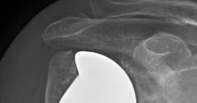 UW Shoulder and Elbow Academy: Revising a loose short stem humeral ...