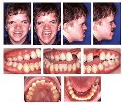 EPÓNIMOS: ENFERMEDAD DE APERT