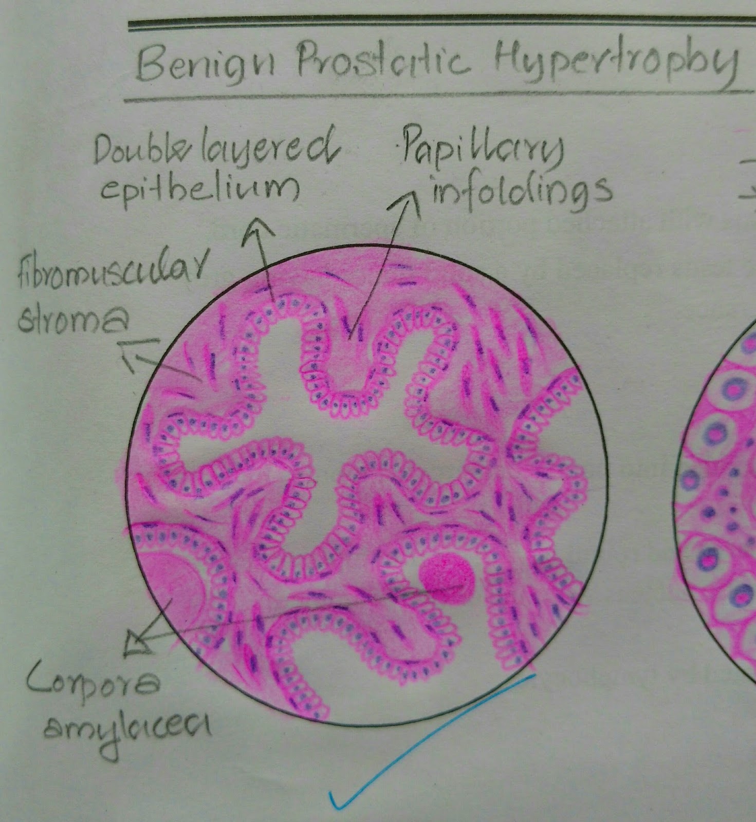 Histopathology Drawings: Benign Prostatic Hypertrophy