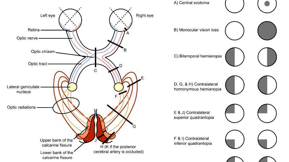 Homonymous hemianopsia