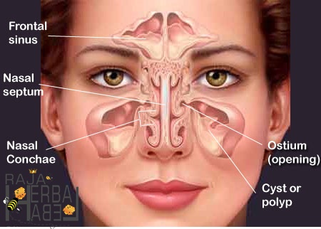 Merinding Melihat Operasi Sinusitis, Begini cara Obati tanpa Operasi ...