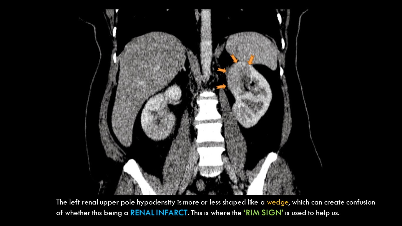 Ultimate Radiology : CASE OF BILATERAL PYELONEPHRITIS
