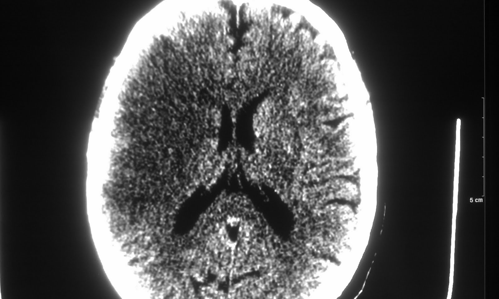 Daily Dose: Stroke window