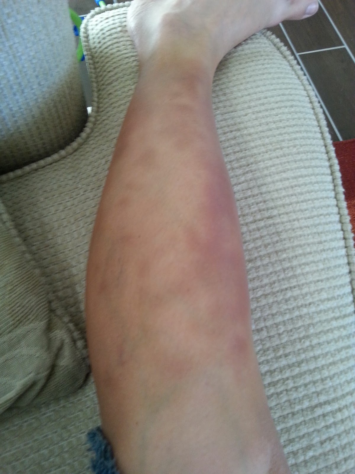 Kim is Obsessed: Graston Technique for Shin Splints