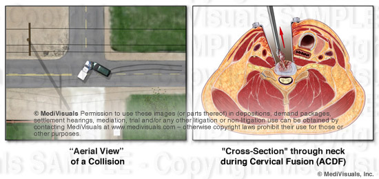 The Medical Legal Exhibit Expert Blog: Medical Legal Illustration and ...
