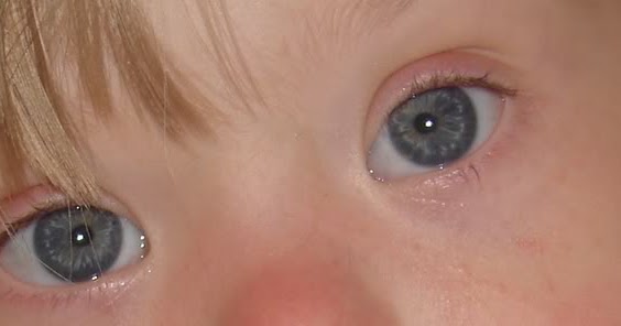 Brushfield Spots Pictures, Causes, Symptoms, Treatment - Health Care ...