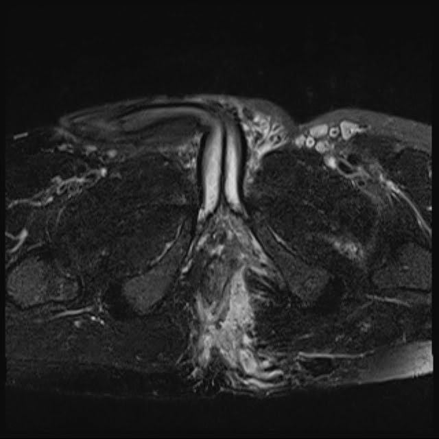 Ischiorectal Abscess Mri Full Article: Preoperative MRI Of Perianal